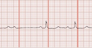 EKG Rhythm Strip Quiz 31