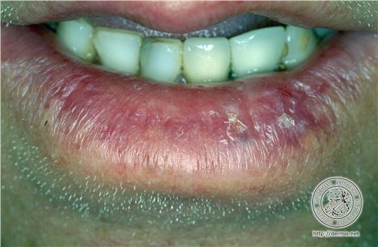 Estomatologia Online: Leucoplasia, Eritroplasia e Queilite Actínica