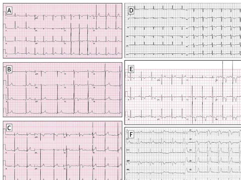Hallazgos Anormales en ECG Atletas (I). International recommendations ...