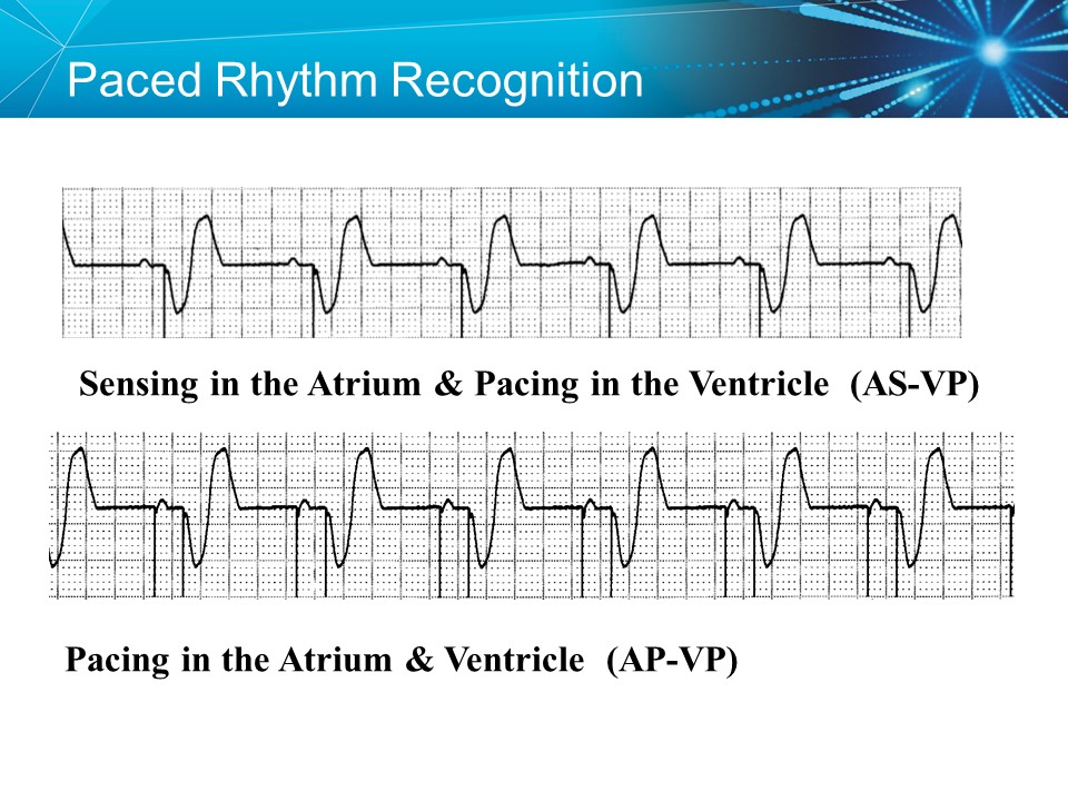 CVT Mohd Farid: Pacemaker Follow Up Part I-Medtronic Academy
