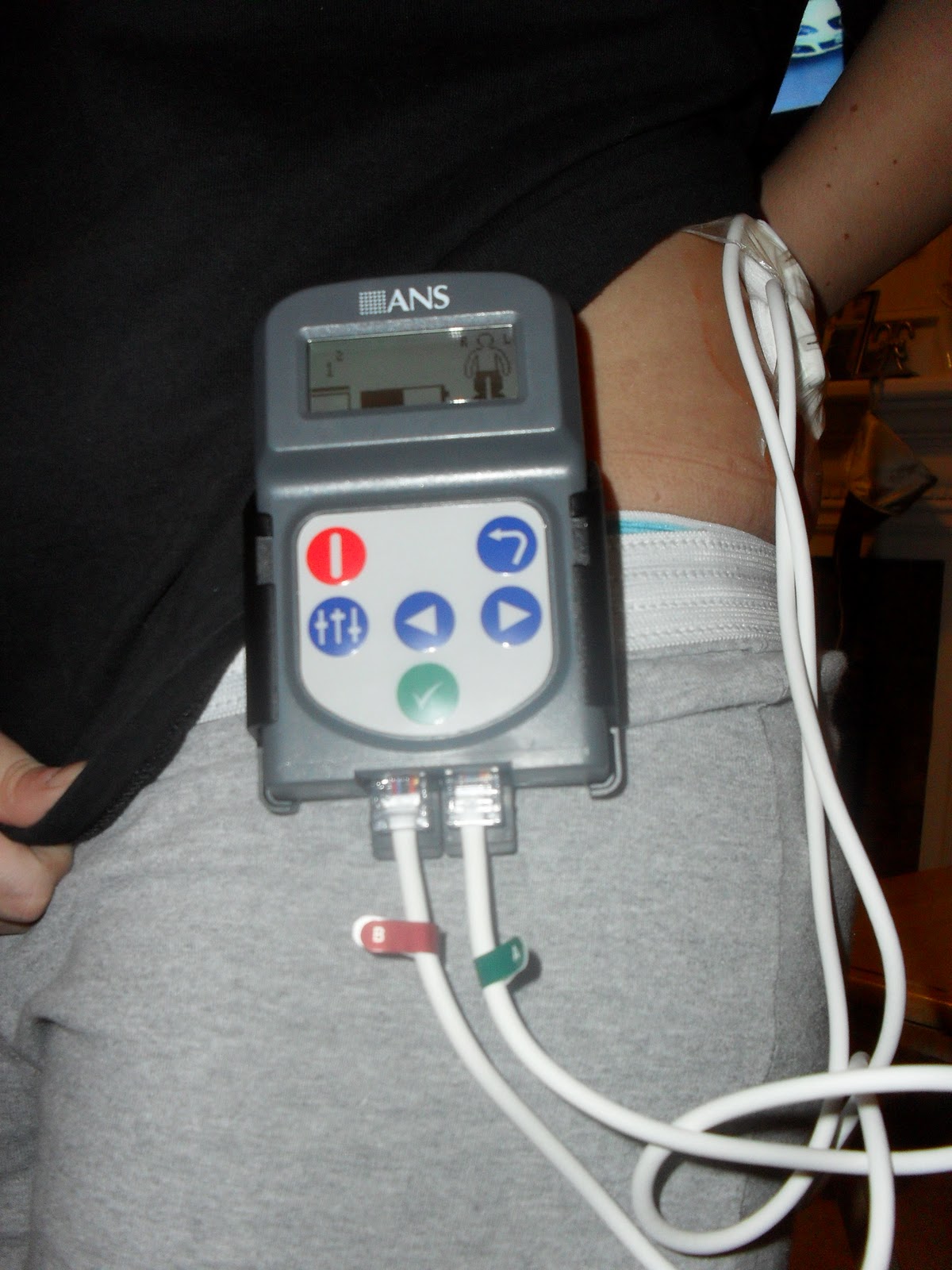 My Journey with CRPS: Day 2 - SCS Trial