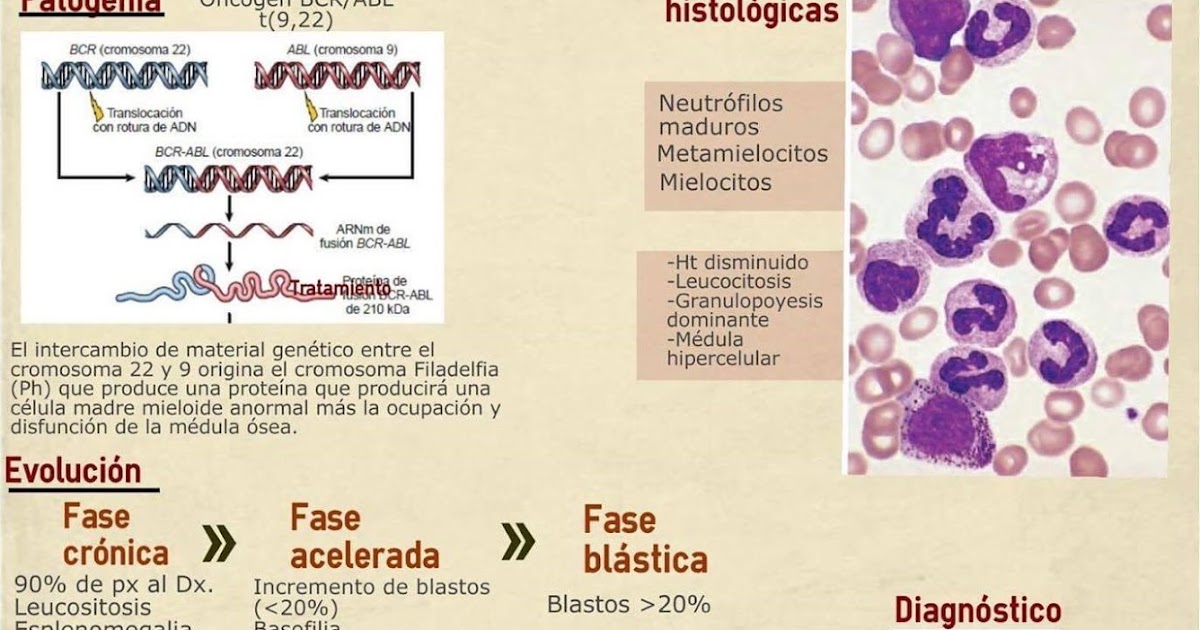 DIVULGACIÓN CIENTÍFICA UG: Leucemia Granulocítica Crónica DIVULGACIÓN CIENTÍFICA UG: Leucemia Granulocítica Crónica