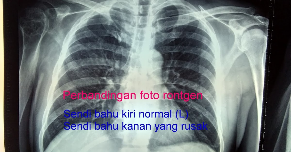 Operasi Menyatukan Sendi Bahu ~ Sendi, Tulang, Otot dan Tulang Belakang