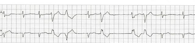 EKG Rhythm Strips 89