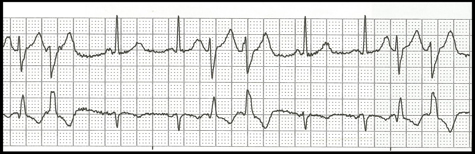 Practice EKG Rhythm Strips 130