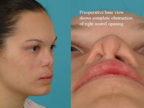 Dr. Dean Toriumi Reviews: Dean Toriumi: Cleft Lip and Reconstructive ...