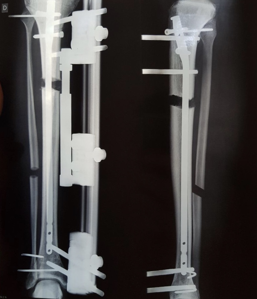 Clinica Orthobone: Alongamento Ósseo