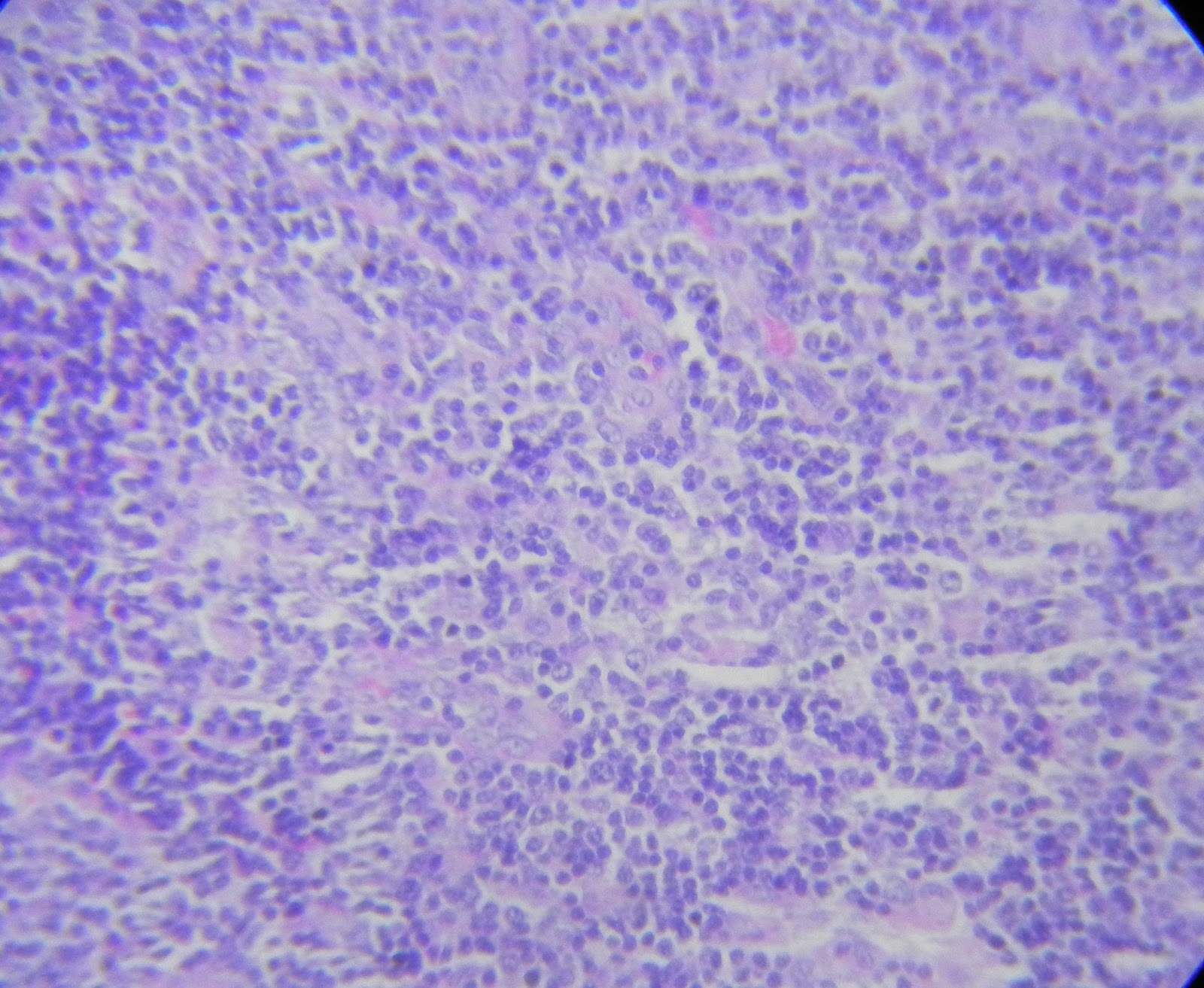 into the roots: A difficult lymph node