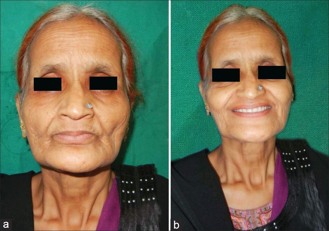 Dental Gallery: Anatomie et physiologie de l’édenté total : Introduction