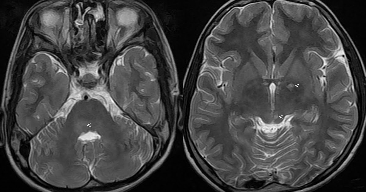 Neuroradiology Cases: Unidentified bright objects (UBO) of NF1