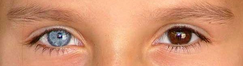Laugh Gags: Heterochromia in humans. Different color eyes