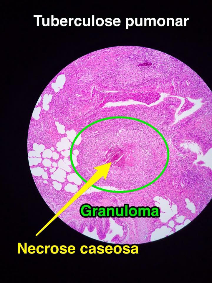 HISTOLOGIA90: TIPOS DE NECROSE