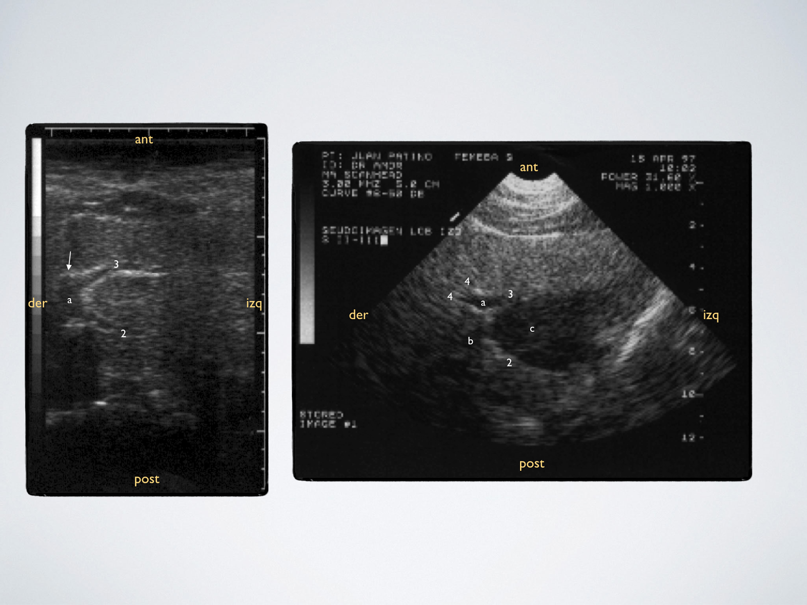 Cuadernos de Anatomía Quirúrgica: Segmentación hepática en ecografía.