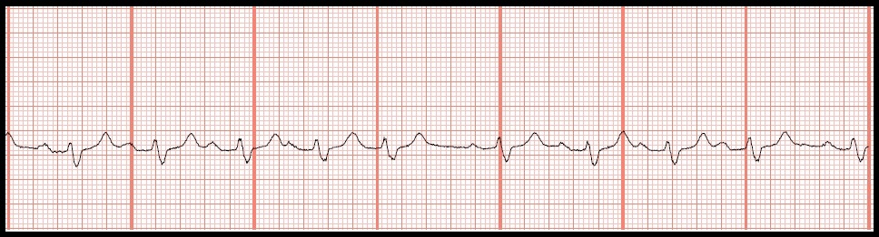 Practice EKG Rhythm Strips 157