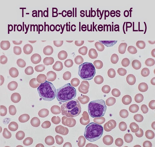 Medical Laboratory and Biomedical Science: Prolymphocytic leukemias