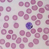 Medical Treatment Pictures-for Better Understanding: Idiopathic ...