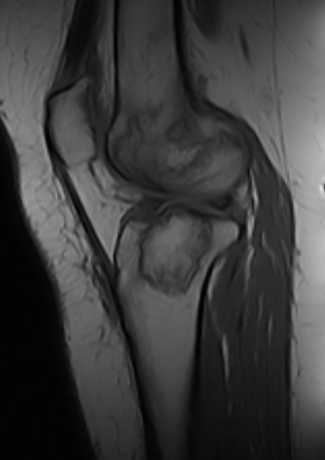 Knee-Avascular Necrosis-MRI - Sumer's Radiology Blog