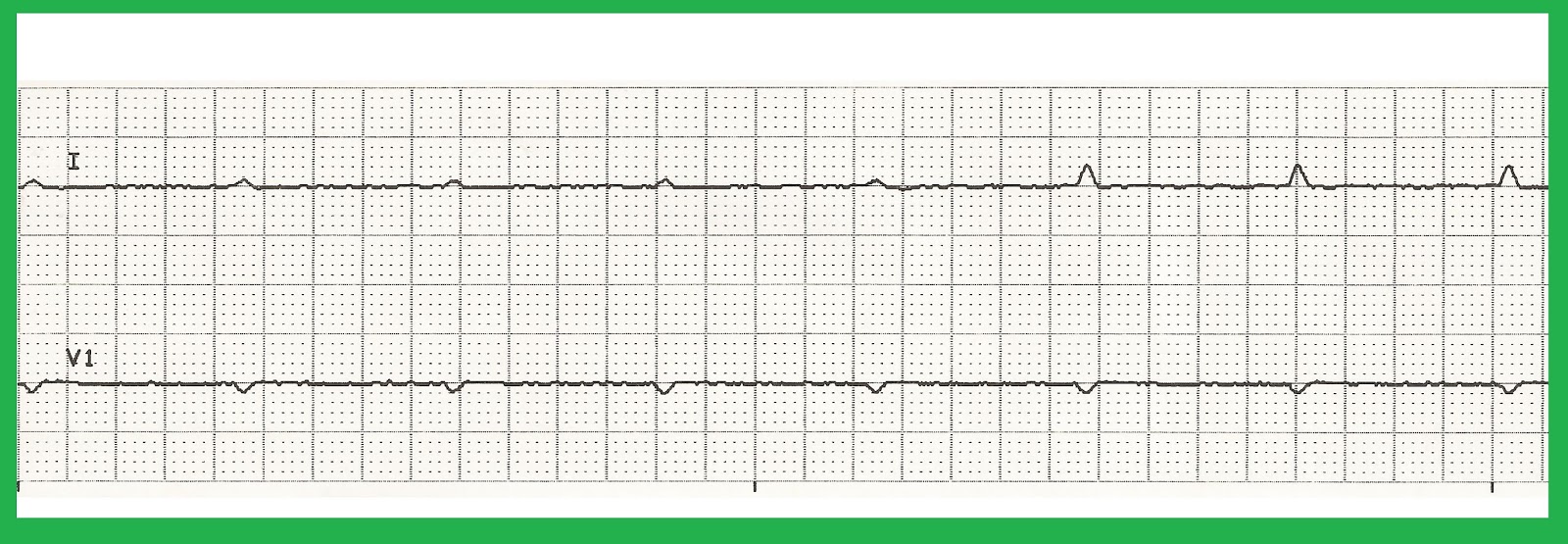 Float Nurse: ACLS review: asystole part 1