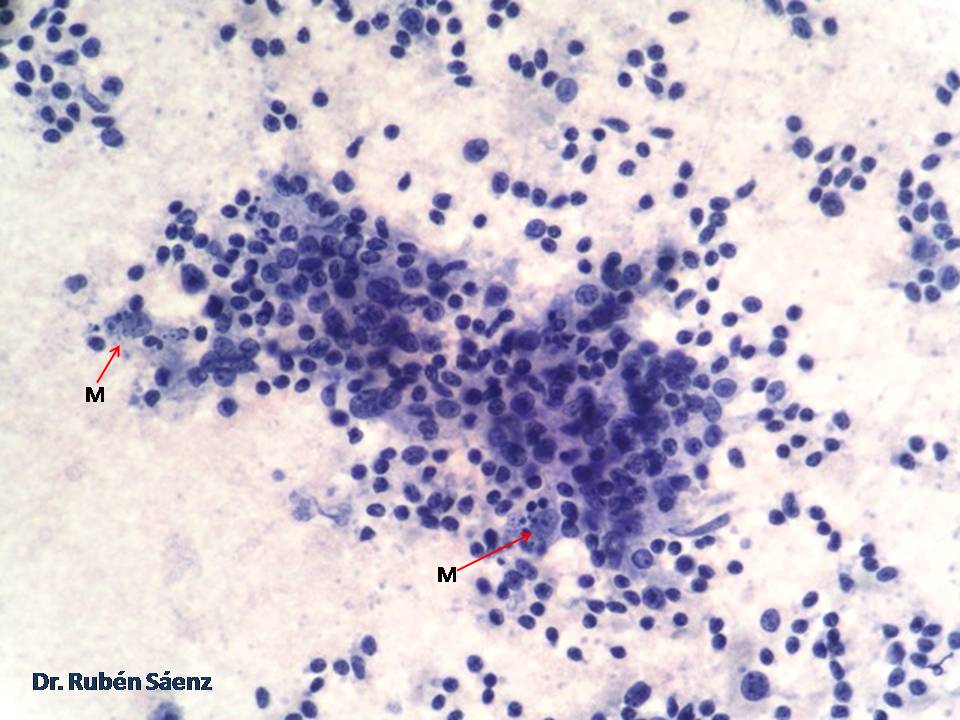THE PERUVIAN CYTOPATHOLOGY CORNER: GANGLIO LINFÁTICO: CENTROS GERMINALES