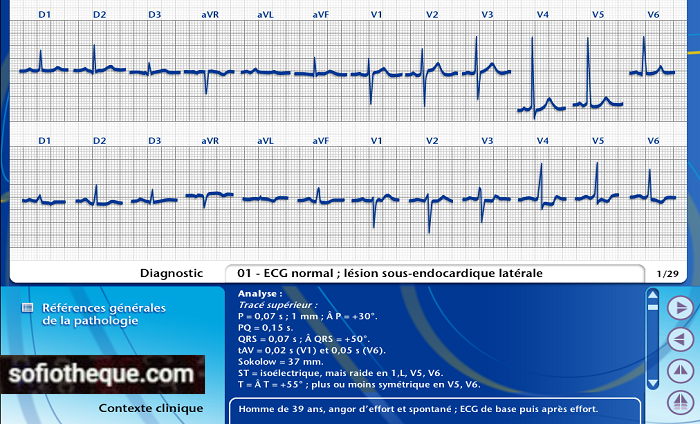 tracé ecg normal