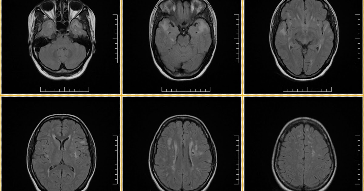 Dr Balaji Anvekar FRCR: CADASIL MRI Brain