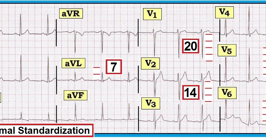 ECG Interpretation: ECG Interpretation Review #73 (LVH – Hypertrophy ...