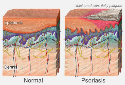 Homeopathic Advice: CONCEPT OF PSORA - INTRODUCTION OF FIRST MIASM IN ...