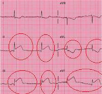 Info Kesehatan: Serangan Jantung