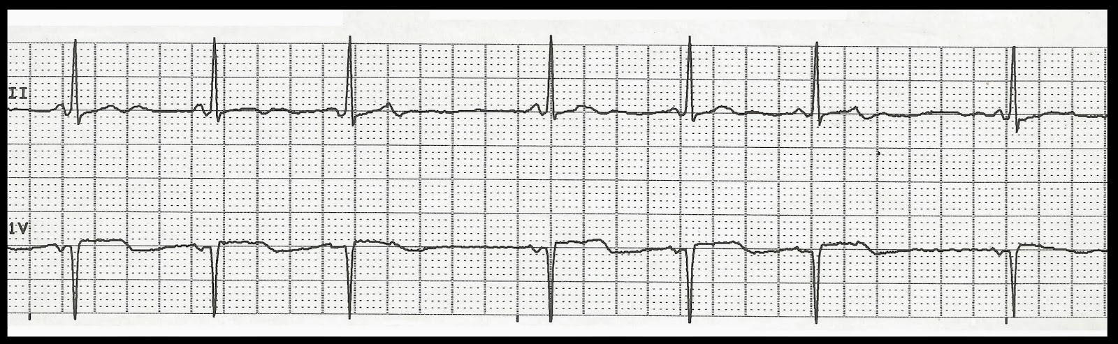 EKG Rhythm Strip Quiz 181