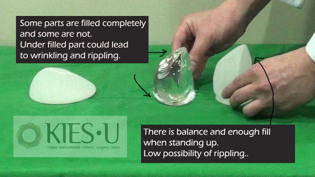 Dr. Lee Breast augmentation Korea: breast implant rippling (textured vs ...