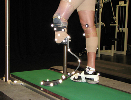 How to Take Care of Prosthetic Leg - Health Articles