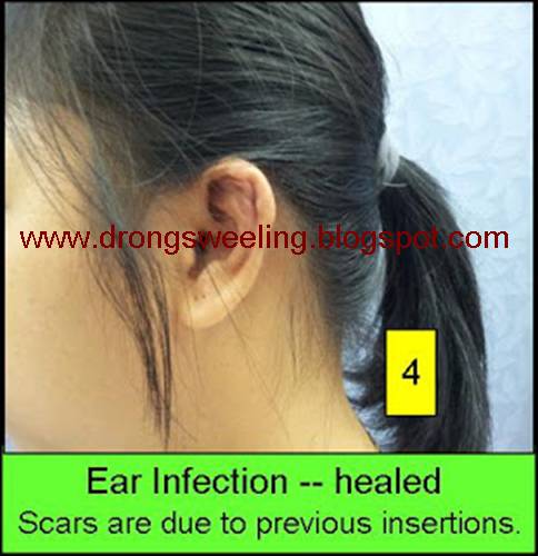 TCM News: TCM healed Man with a Boil, Abcess