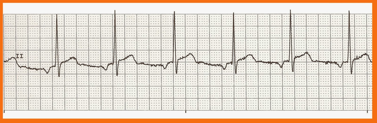 Practice Rhythm Strips 245