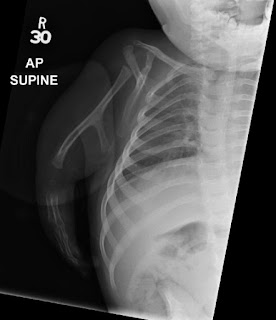 Severe Ulnar Deficiency | Congenital Hand and Arm Differences ...