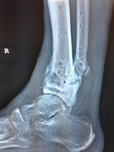 Paul Bours: #Paul #Bours - Surgical risk and complications