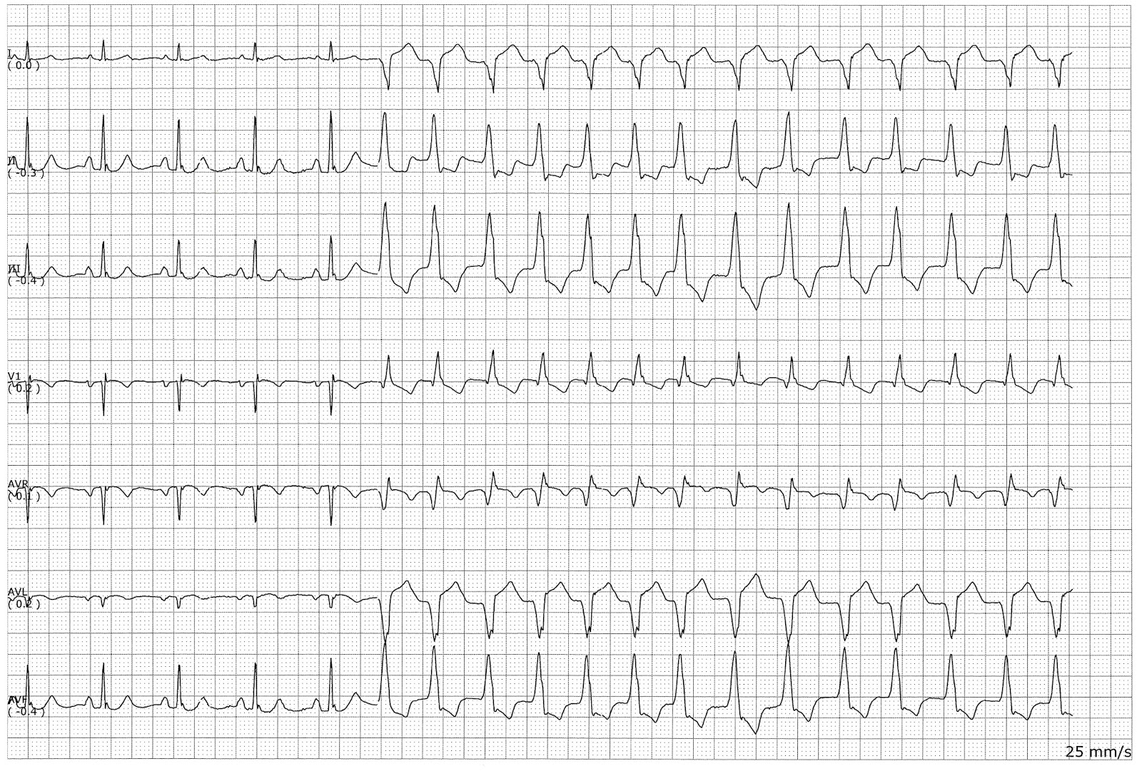 Sinus Rhythm with Run of Ventricular Tachycardia