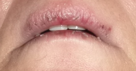 My cure for exfoliative cheilitis (chronic peeling and cracking of the ...