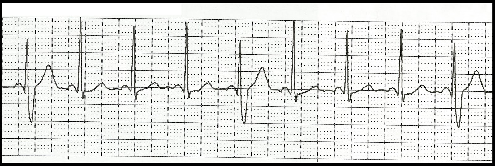 EKG Rhythm Strip Quiz 108