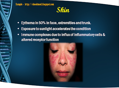 Systemic Lupus Erythematosus Powerpoint Presentation Free Download - E-MED