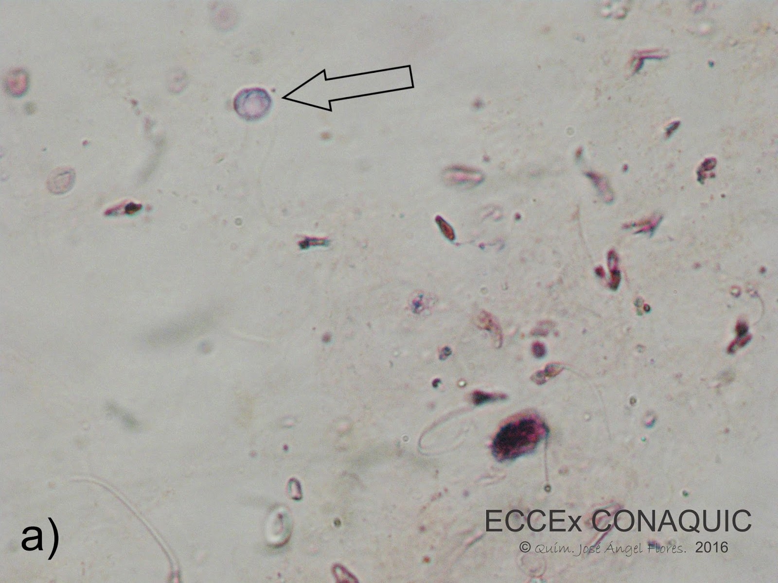 Caso UR-mayo-16 (Enfoque: espermaturia)