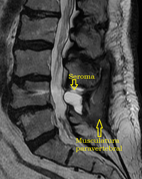 El Baúl Radiológico: SEROMAS POSTQUIRÚRGICOS PARAVERTEBRALES (Lumbar ...