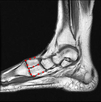 MRI Musculo-Skeletal Section: Bipartite medial cuneiform.