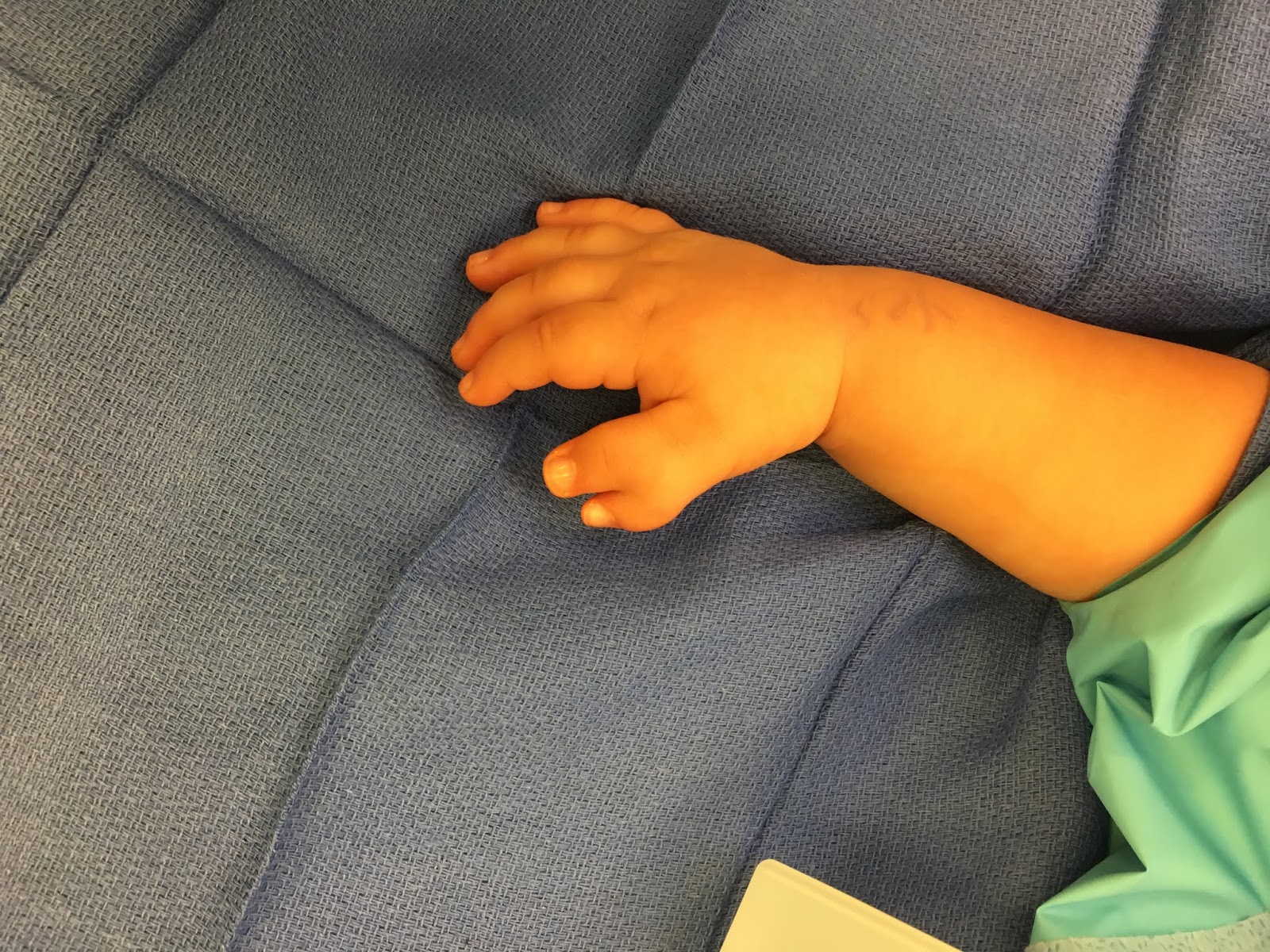 Extra Thumb Reconstruction | Congenital Hand and Arm Differences ...