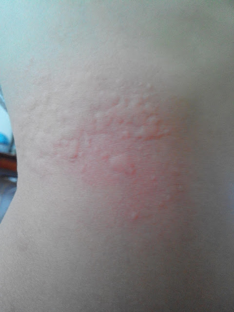 9 Petua Berkesan Hilangkan Gegata Pada Badan Anda