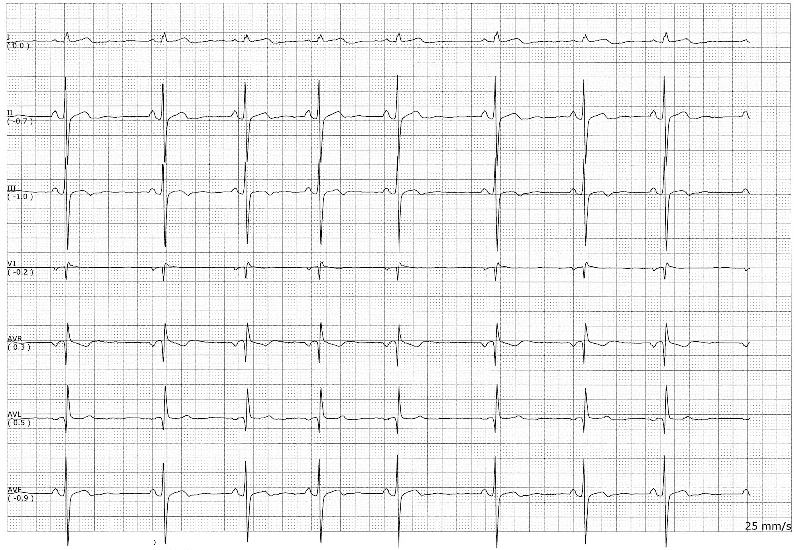 Sinus Bradycardia with Sinus Arrhythmia