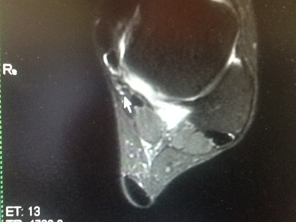 Foot and Ankle Problems By Dr. Richard Blake: Tarsal Tunnel Syndrome ...