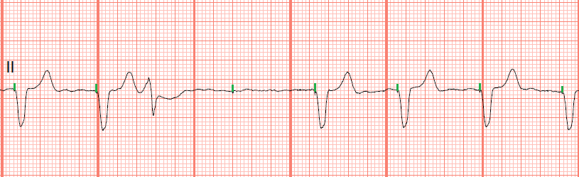 Basic EKG Rhythm Test 46