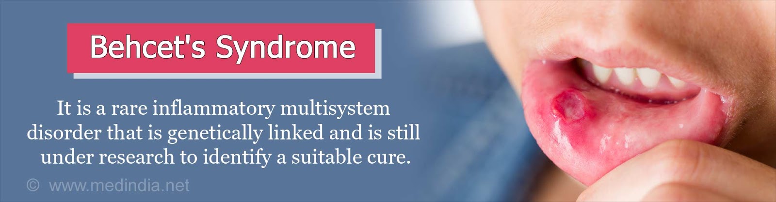 Boala Behcet