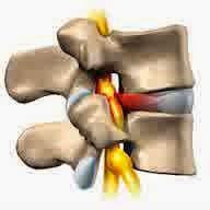 Pathophysiology of Herniated Nucleus Pulposus (HNP) - Blog Nursing Care ...