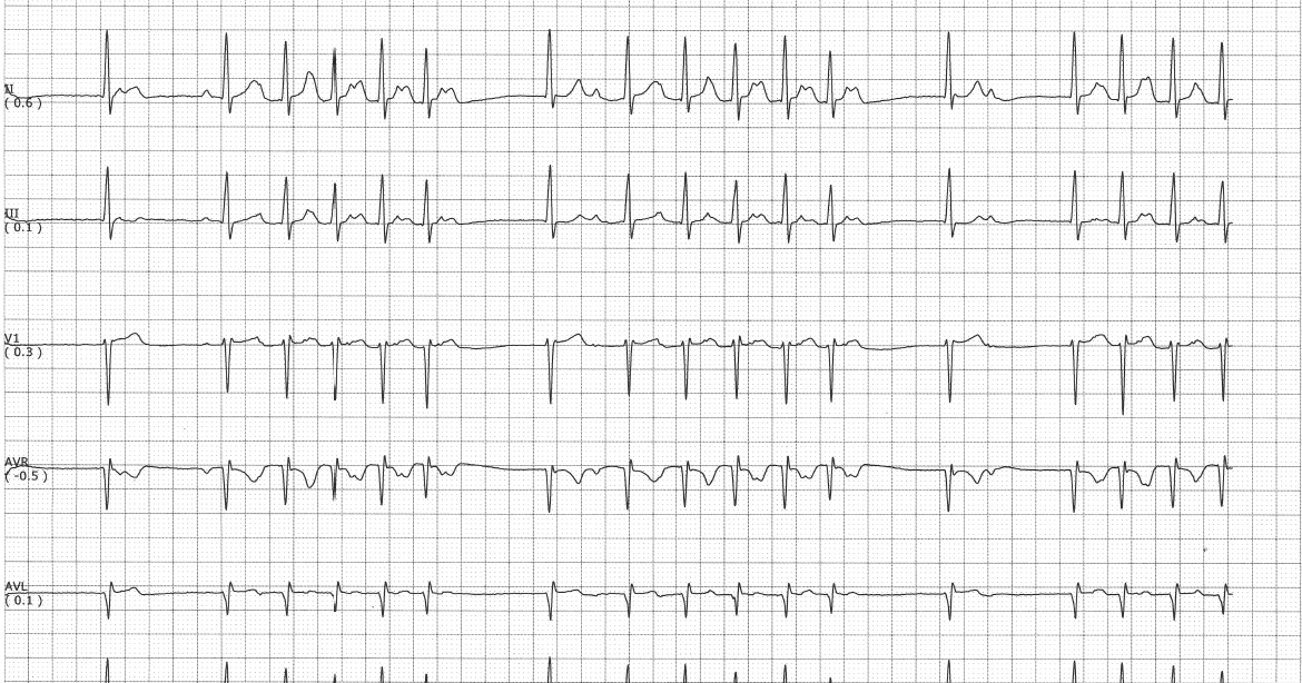 Float Nurse: Practice EKG Strips